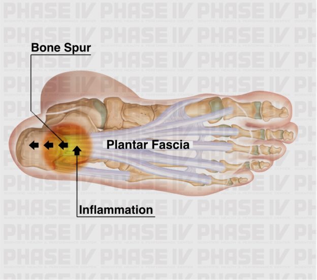 Plantar Fascia