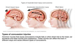 Concussion Facts